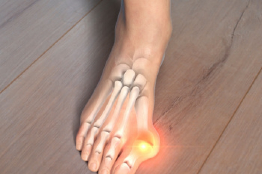 A Visual Analysis of a Bunion